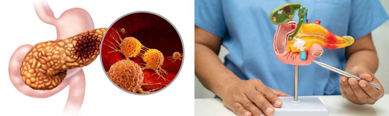 Chronic Pancreatitis Treatment | Curative Digestive Disease Center